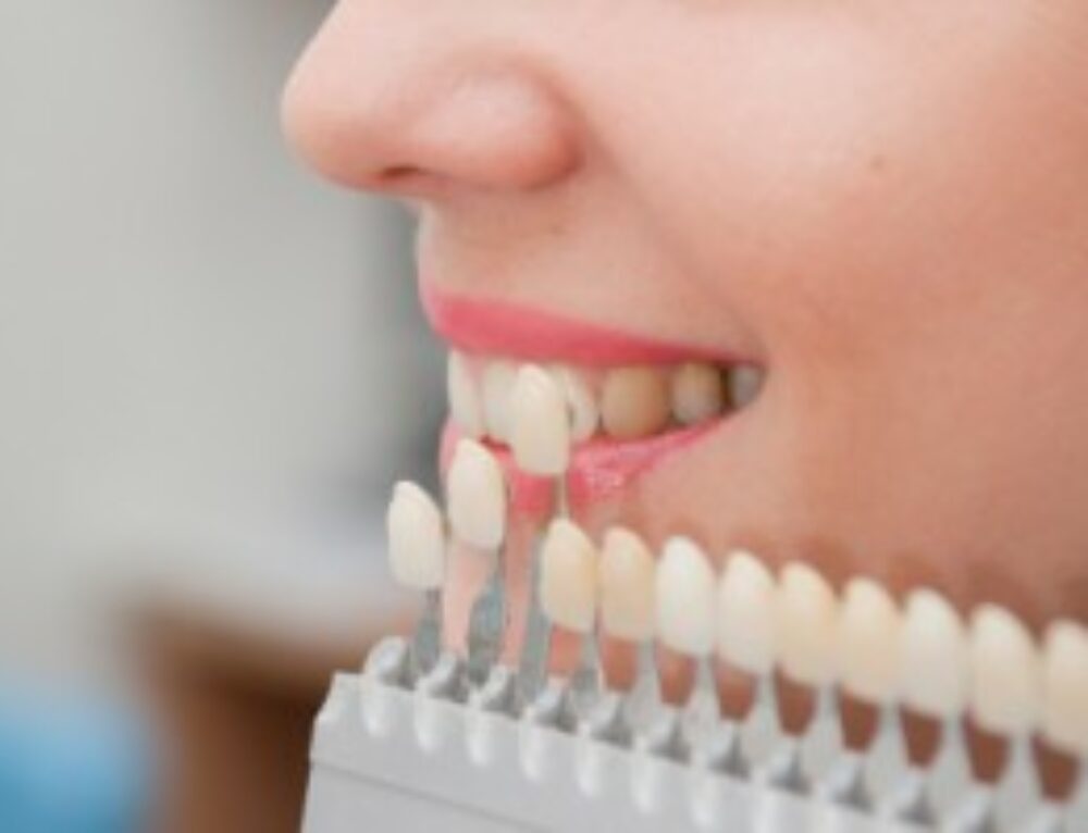 Everything You Need to Know About Dental Veneers - Washington DC ...